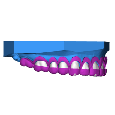 DSD Crown Lengthening Guide Design