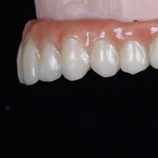 Full Arch Implant Bridge Manufacture (B Components)