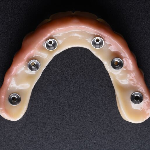 Full Arch Implant Bridge Manufacture (B Components)