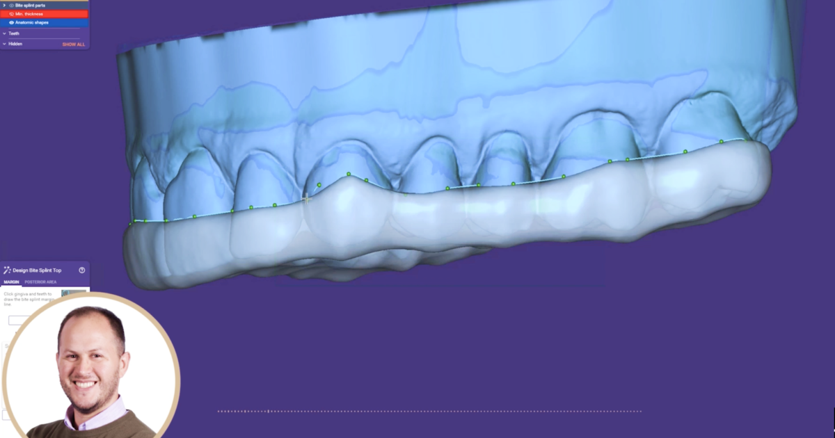 Bite Splint design tips from the DSD Planning Center