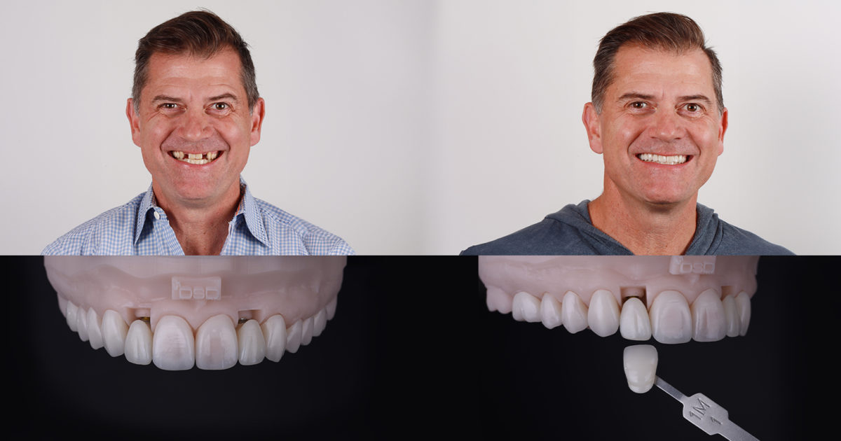 Complex Implant Case solved with DSD Natural Restorations