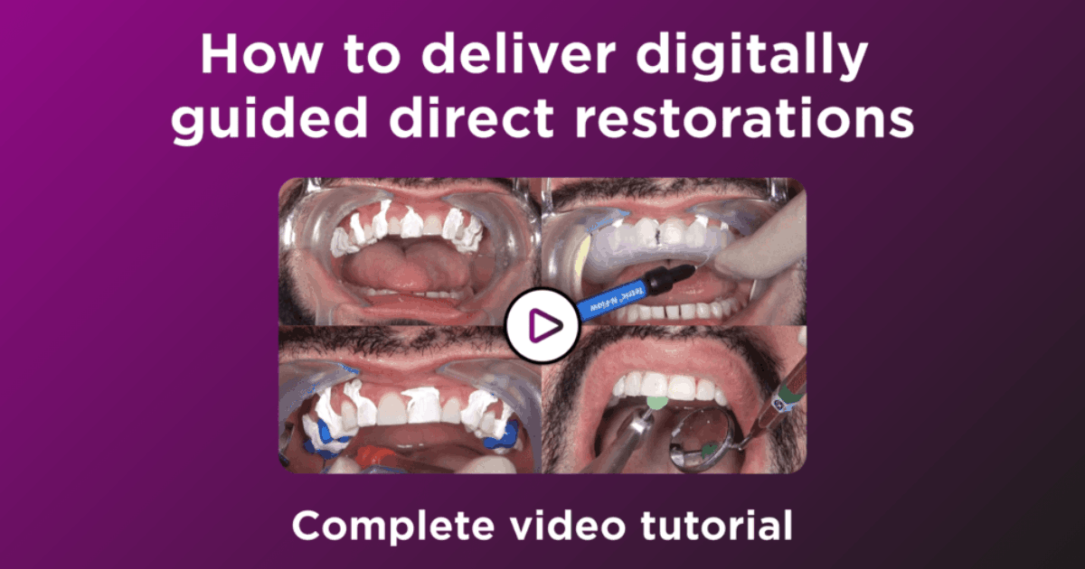 Digitally guided direct restorations video tutorial