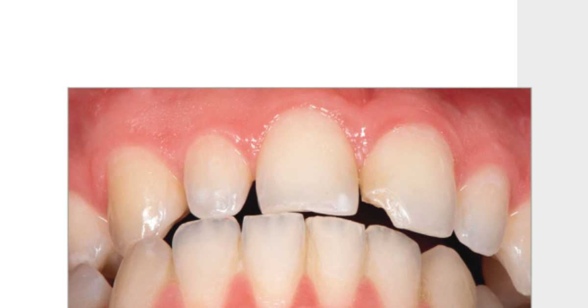 Photographic-assisted prosthetic design technique for the anterior…