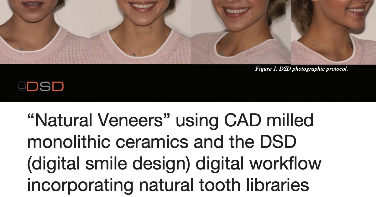 “Natural Veneers” using CAD milled monolithic ceramics and the DSD…