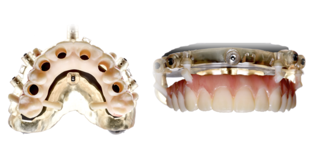 Clinical article: The DSD ClicGuide System: a clinical report of…