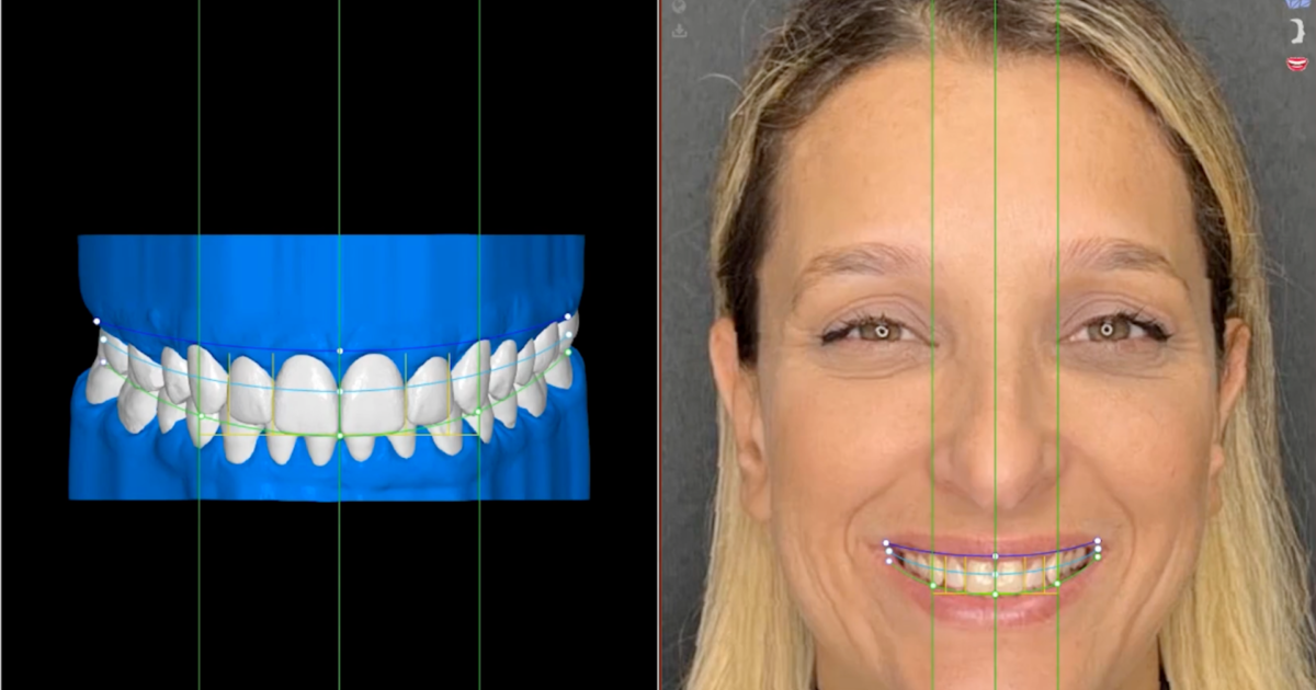 What is the DSD Upper and Lower?