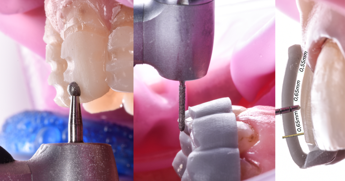 Over and under prepping