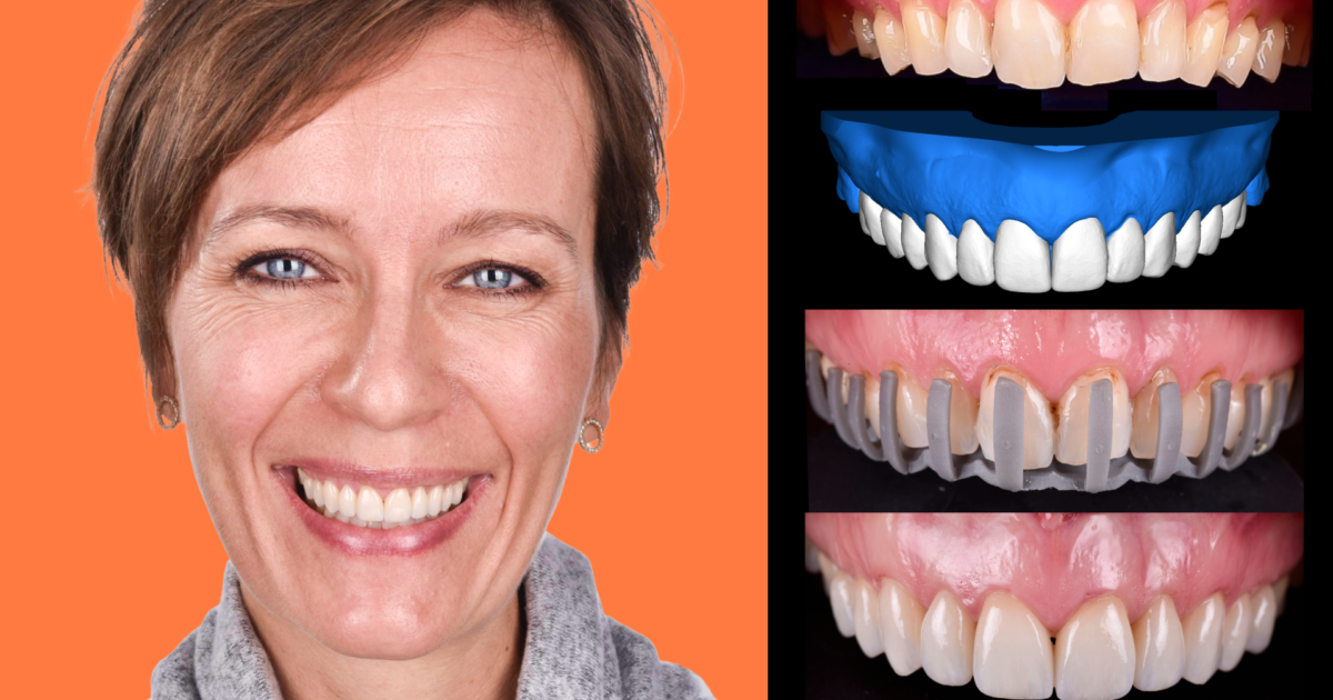 Standard vs. digitally guided protocols: A veneers case study