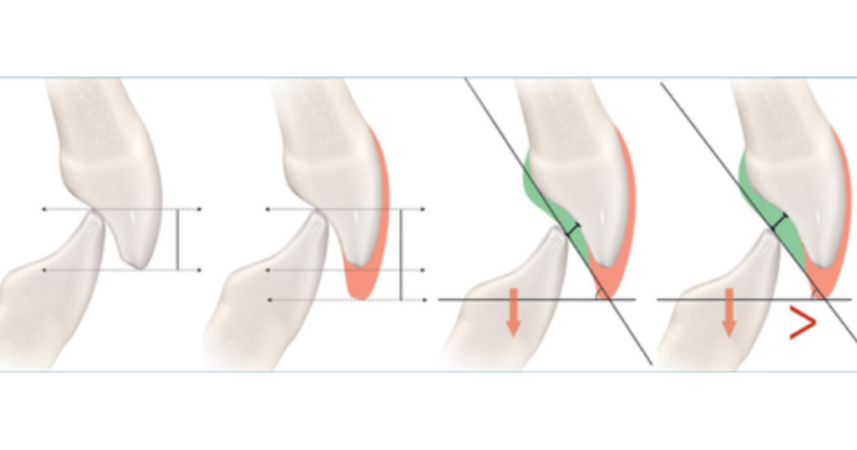 Clinical article: Occlusal vertical dimension: treatment planning…