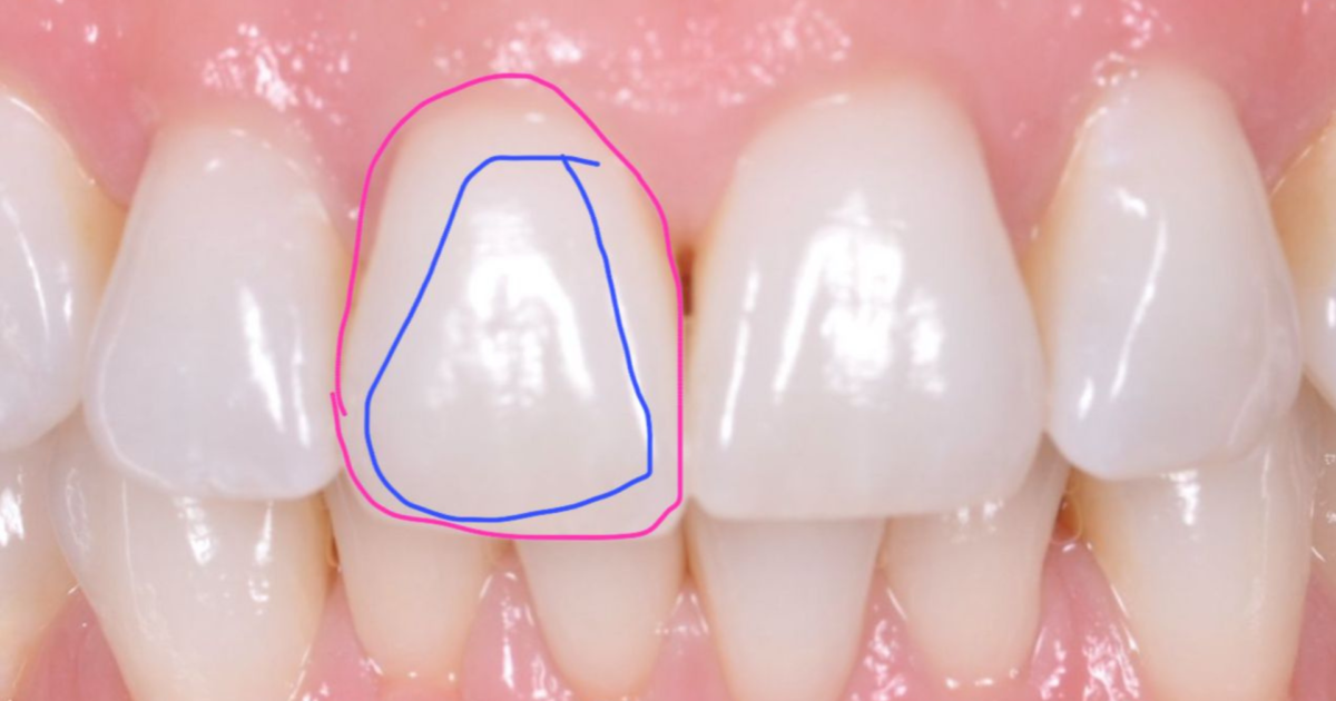 Understanding real vs. perceived dental shape: the key to overcome…
