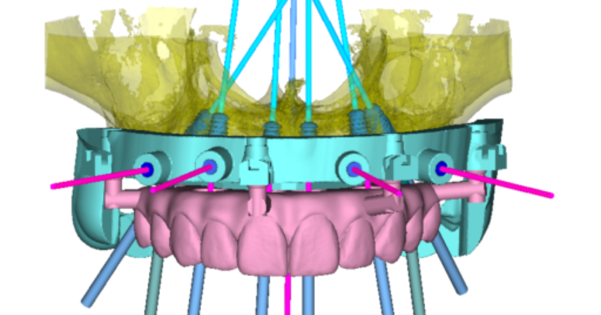 DSD Clic Guide Design