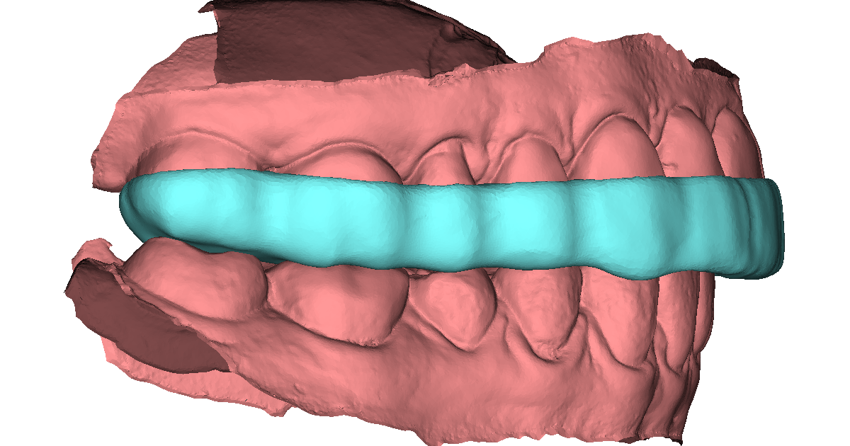 DSD Bite Splint Design