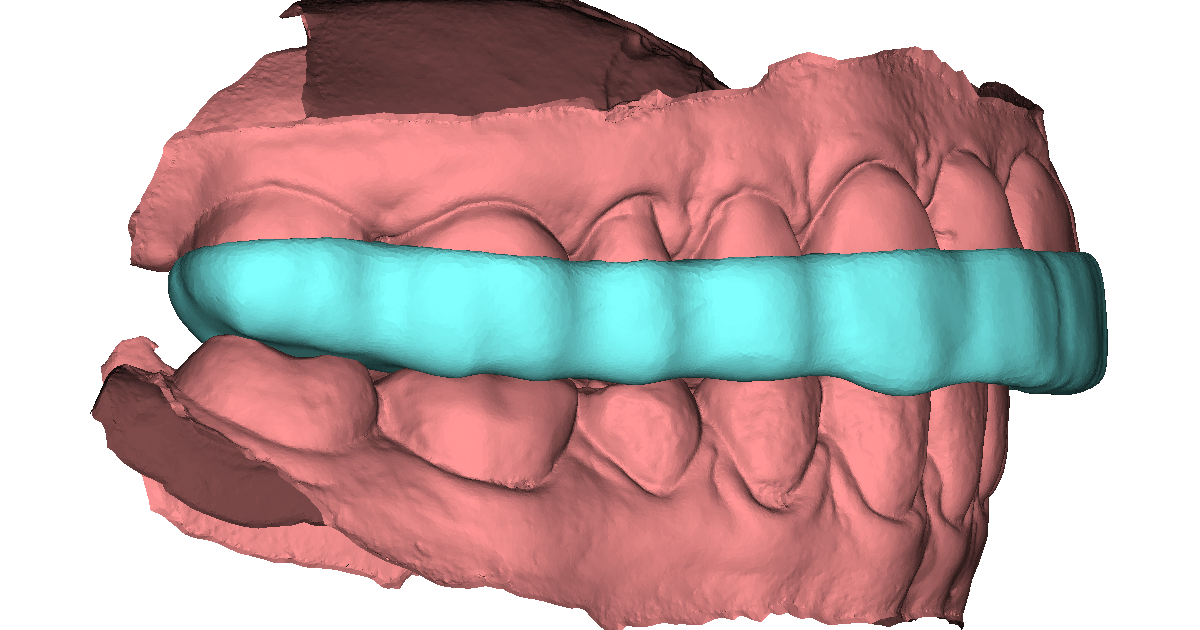 DSD Bite Splint Design