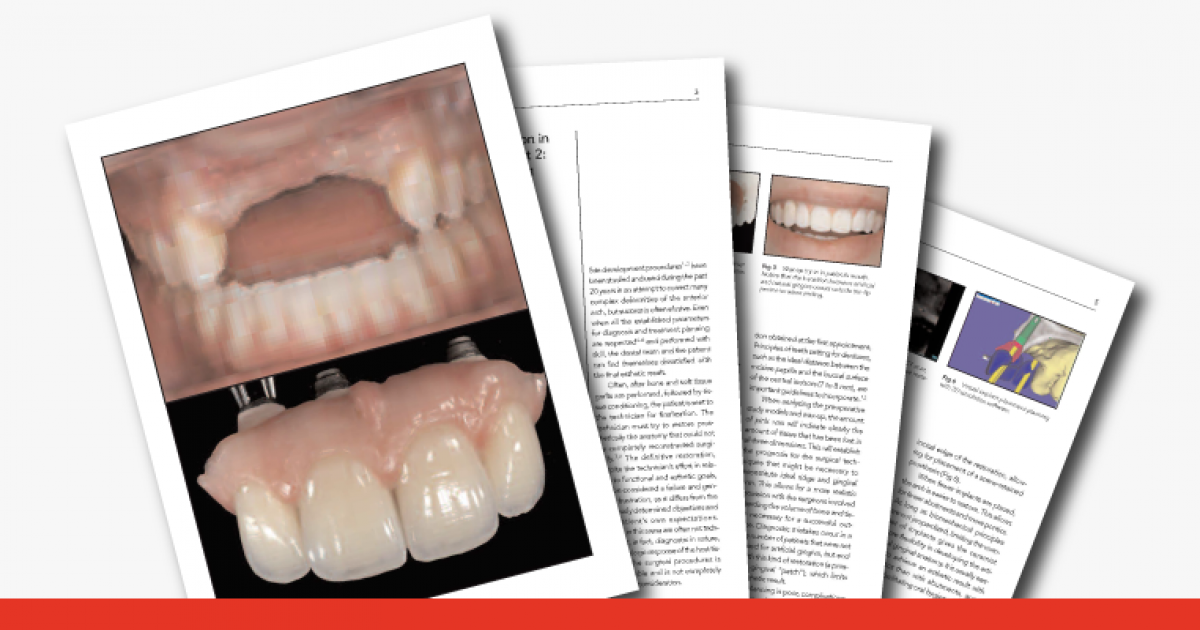 (Part 2) Prosthetic Gingival Reconstruction in the Fixed Partial...