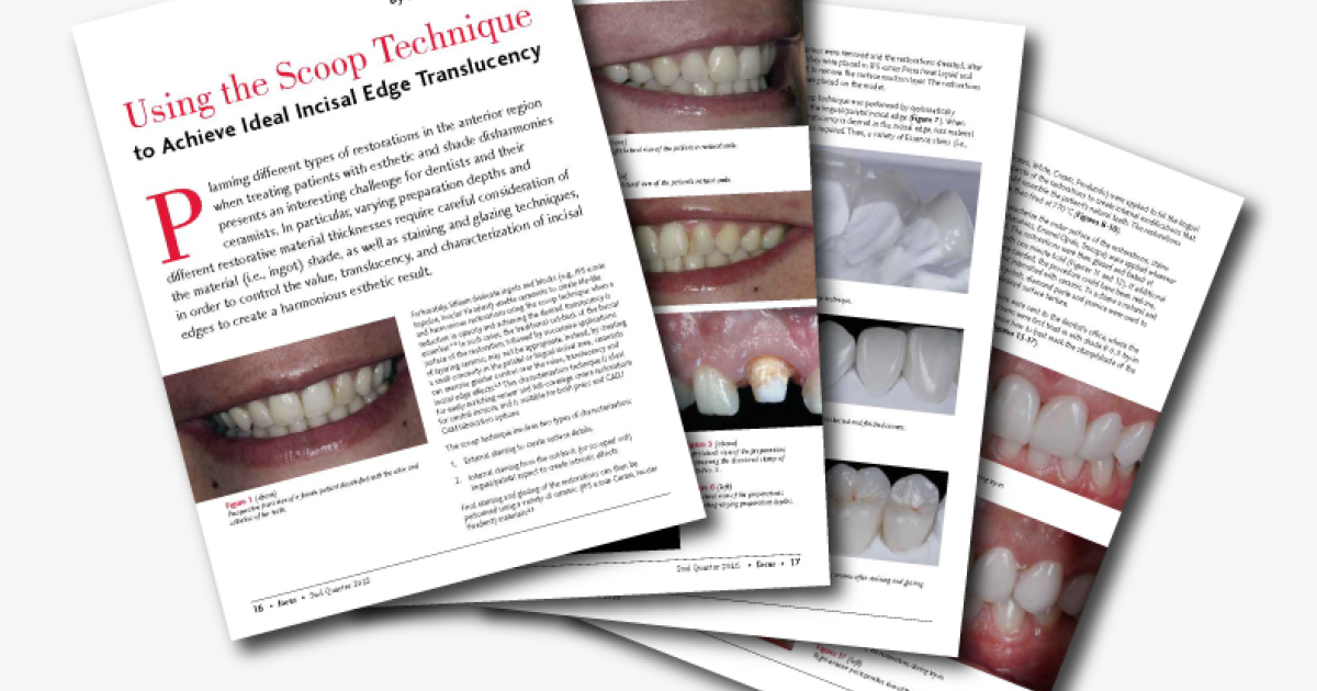 Using the Scoop Technique to Achieve Ideal Incisal Edge Translucency